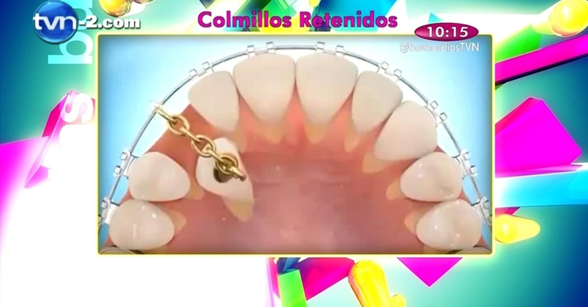 Vídeo | Salud Dental - Colmillos Retenidos - Vídeos | Tvn Panamá