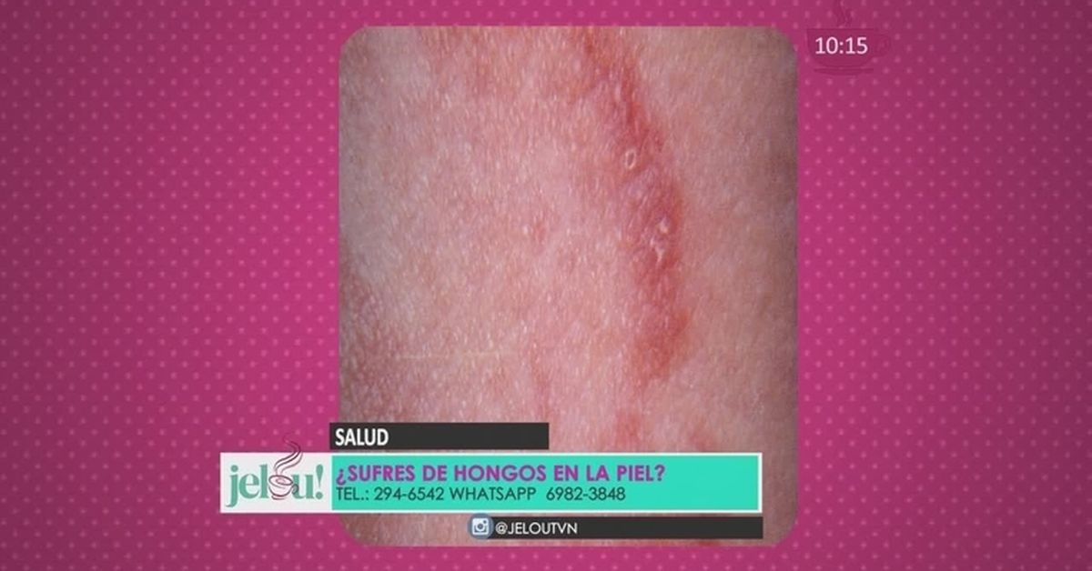 Vídeo | ¡Hongos en la piel! Descubre como tratarlos. - Dr. Gustavo ...