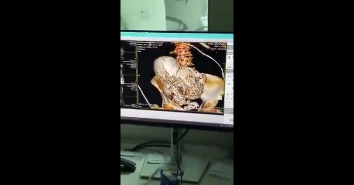 Feto calcificado | Mujer brasileña muere en operación para retirarle un ...