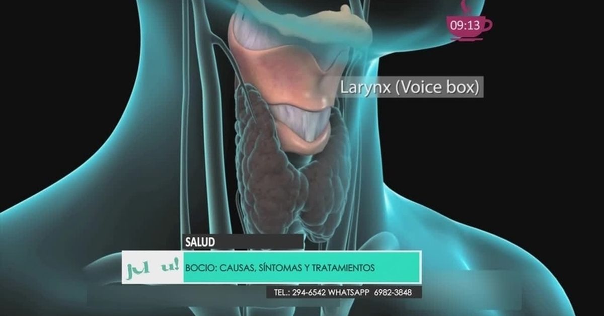 Vídeo | ¿Sabes que es el bocio? Sus sintomas, causas y tratamientos aquí te lo diremos - Dr ...