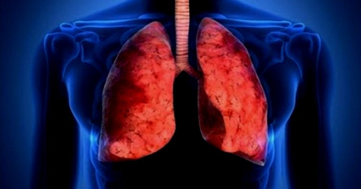 Qué es la tuberculosis: ¿Qué es la tuberculosis? Conoce los síntomas ...