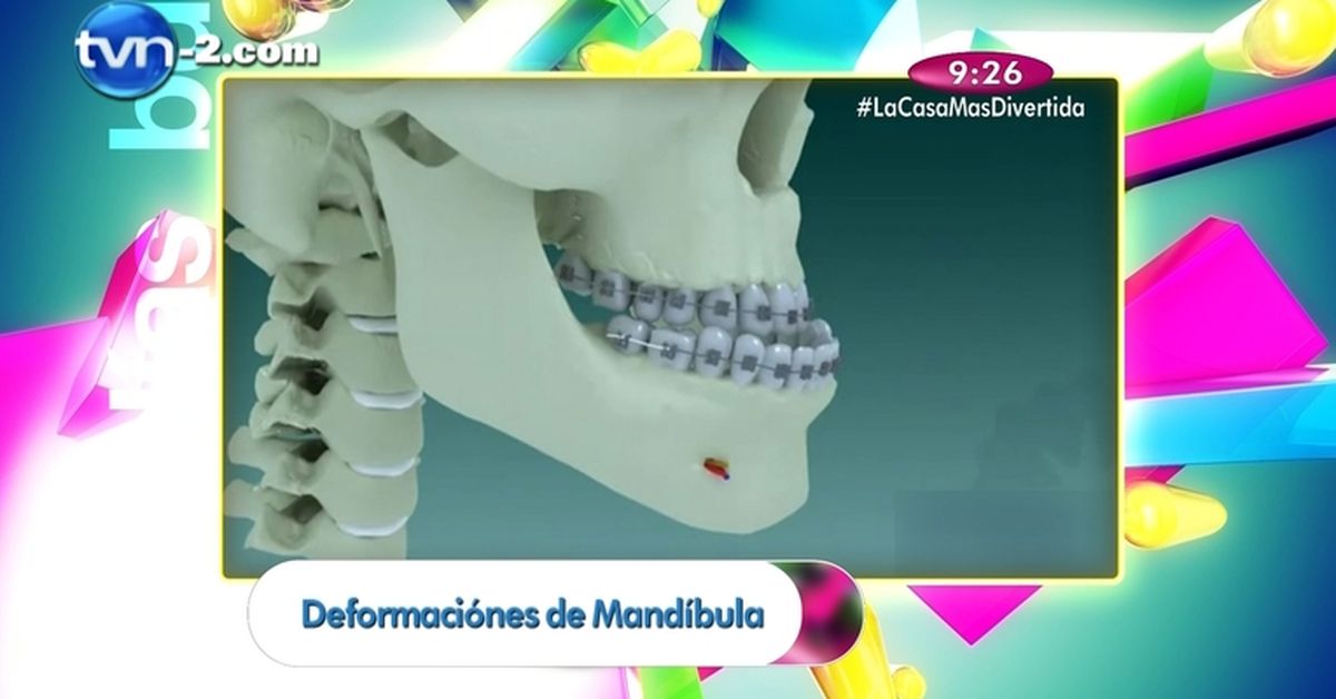 Vídeo | Salud Dental - Deformaciones del la Mandíbula - Vídeos | Tvn Panamá